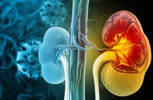 Kidney Failure Signs: How to Recognize Symptoms and Key Indicator ...